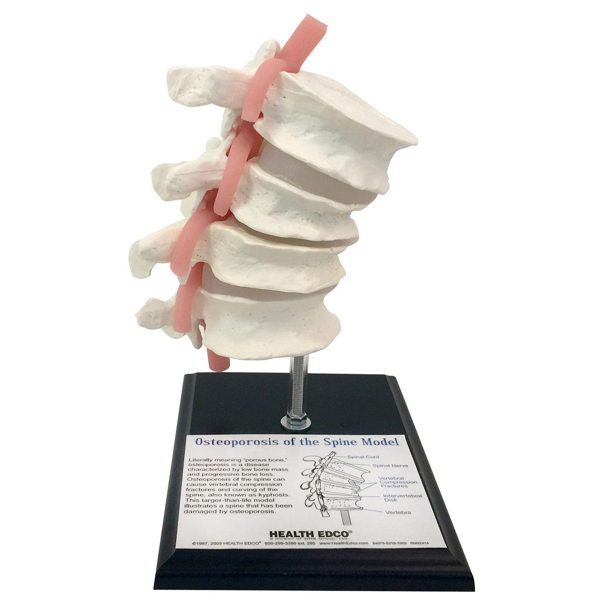 Lumbar Spine Disk Degeneration Model- Vertebrae – Buyamag INC