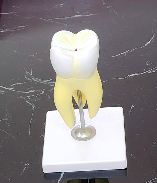 Human Molar Teeth Model: With Cavities | Buyamag – Buyamag INC