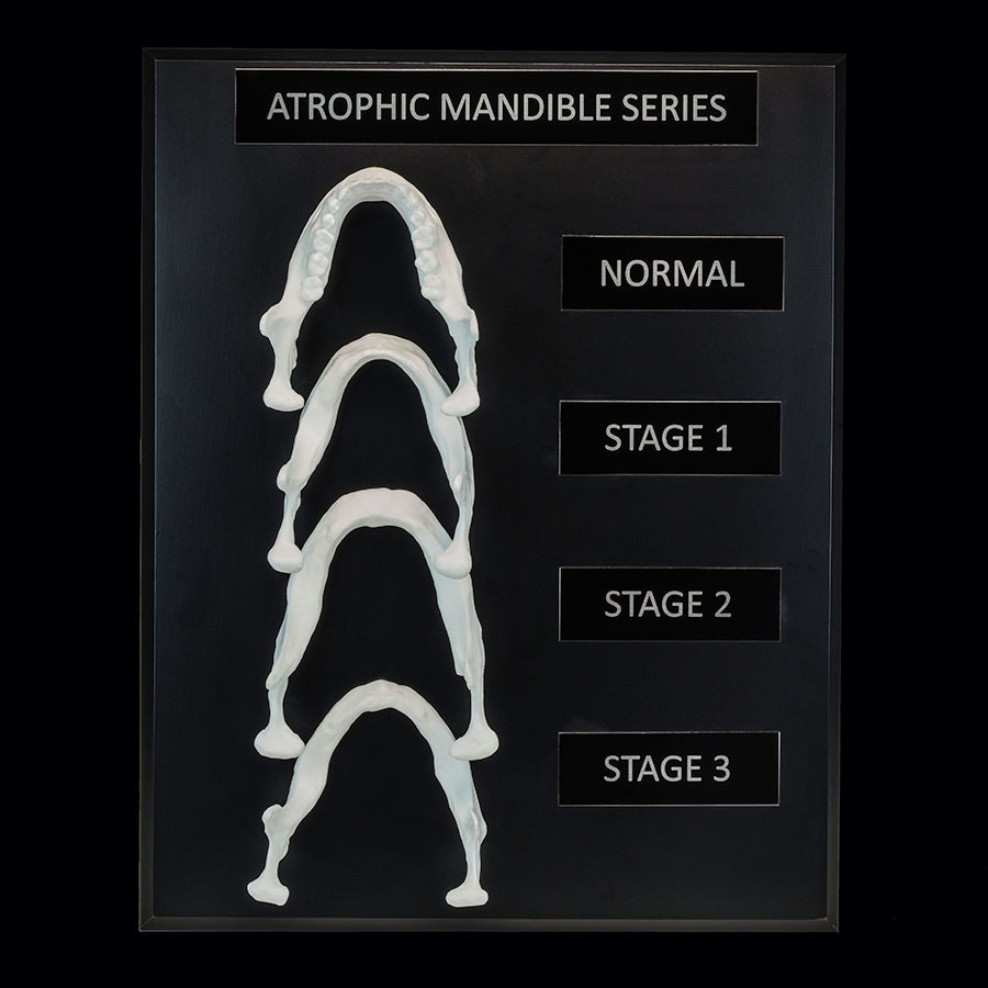 Atrophic Mandible - Model 4 Series | Buyamag inc – Buyamag INC