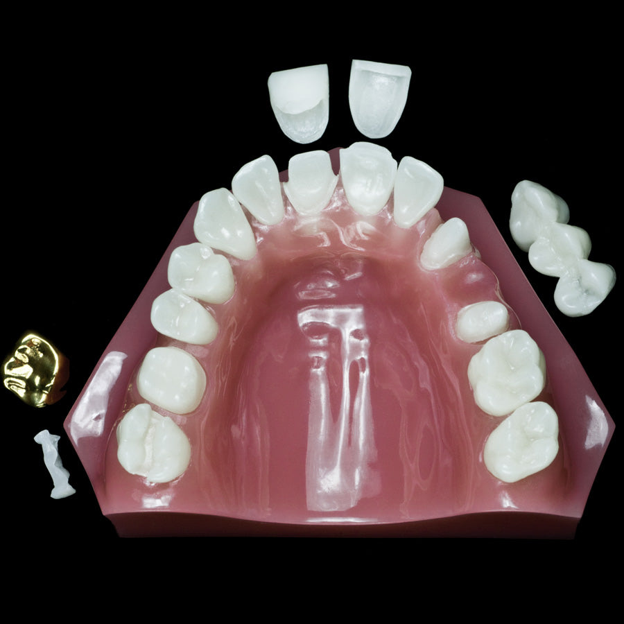 Dental Gold Crown: Bridge Veneer | Model Buyamag – Buyamag INC