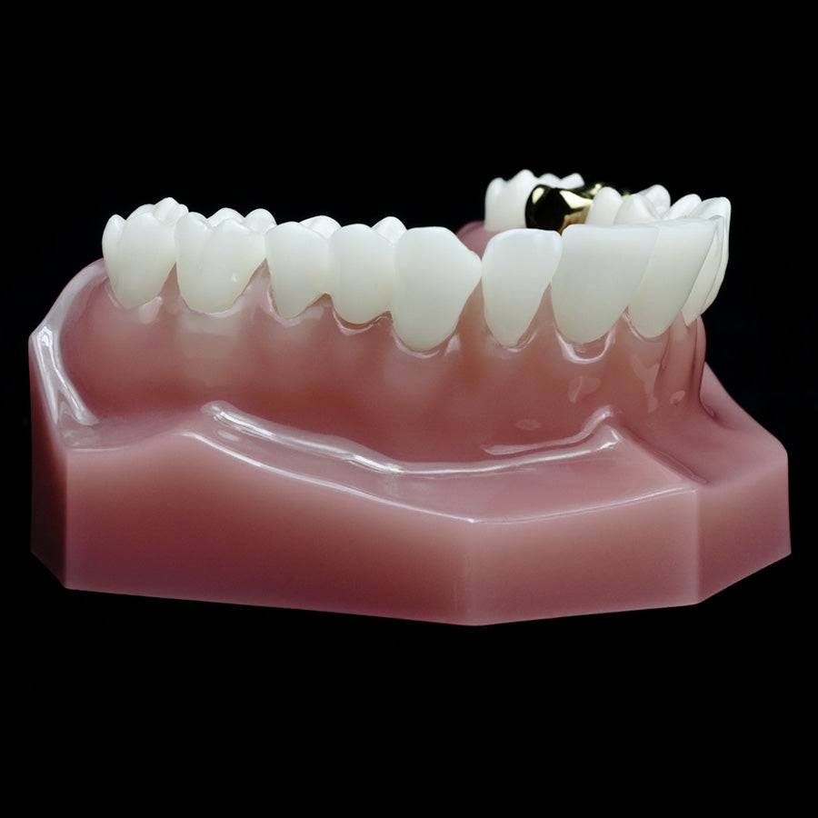 Dental Gold Crown: Bridge Veneer | Model Buyamag – Buyamag INC