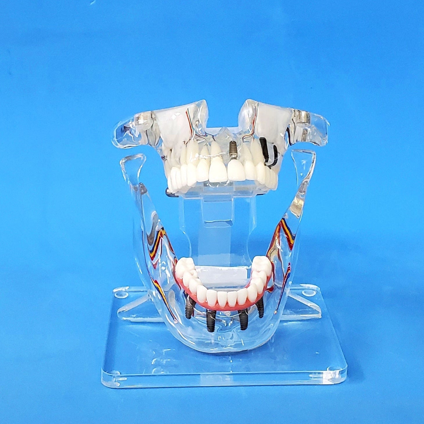 Sinus Lift Model Implants 2 Dental Bridges- Buyamag – Buyamag INC