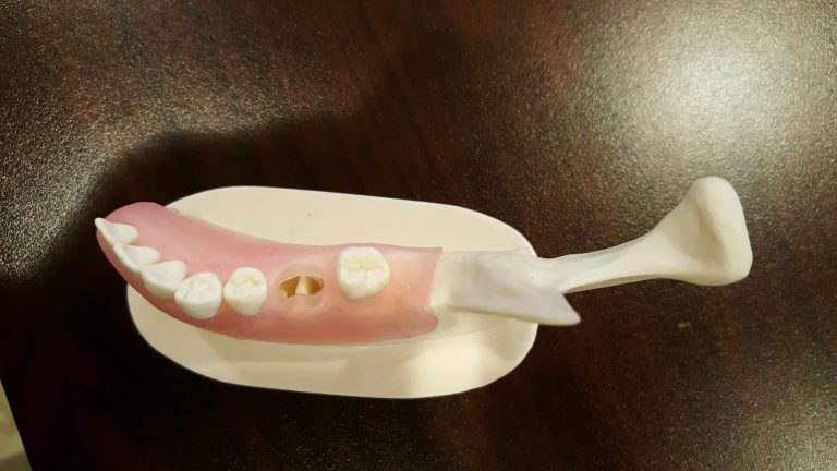 Dental Socket Grafting: Practice Model - Buyamag – Buyamag INC