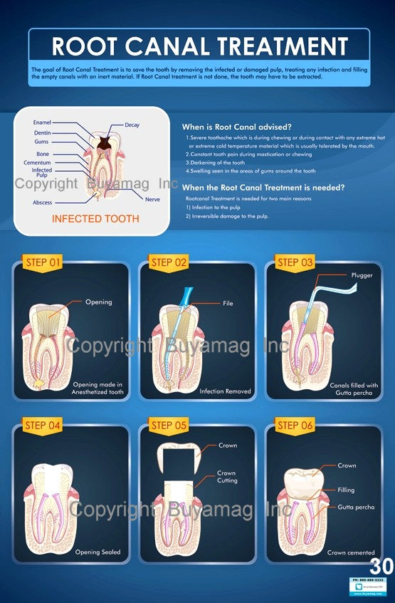 Dental Poster Root Canal Treatment Office Patient Education – Buyamag INC