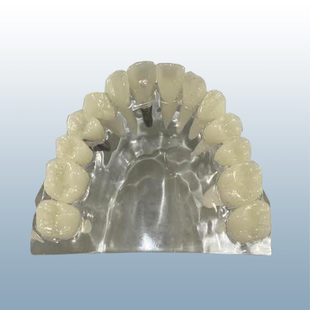 Dental Porcelain Bridge Implant | Supported Model – Buyamag INC