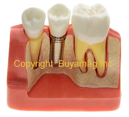 Dental Bridge Implant Crowns Set Model | – Buyamag INC