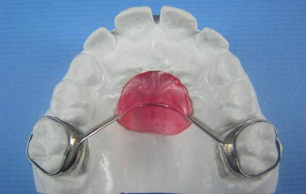 Nance Retainer Orthodontic Model: Buyamag – Buyamag INC