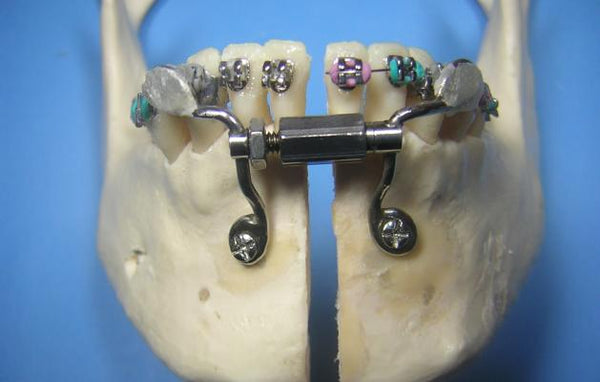 Distraction Osteogenesis - Orthodontic Model Buyamag – Buyamag INC