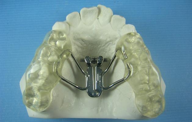 Bonded Fan Exspider Expansion Ortho Model- Buyamag – Buyamag INC