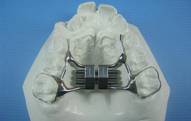 Standard Rapid Palatal Expander Orthodontic Model – Buyamag INC