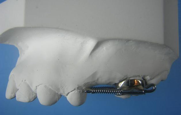 Space Regainer Orthodontic Model – Buyamag INC