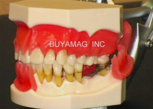 Periodontal Hygiene Disease Model | Gum Reseeding Buyamag – Buyamag INC