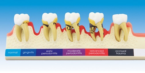 Periodontal Disease Demonstration Model 2x Enlarged Size – Buyamag INC
