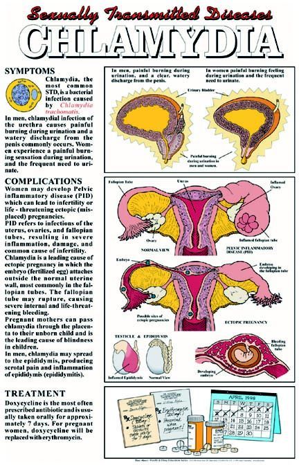 Chlamydia Poster Safe Sex Poster Charts - Buyamag – Buyamag INC