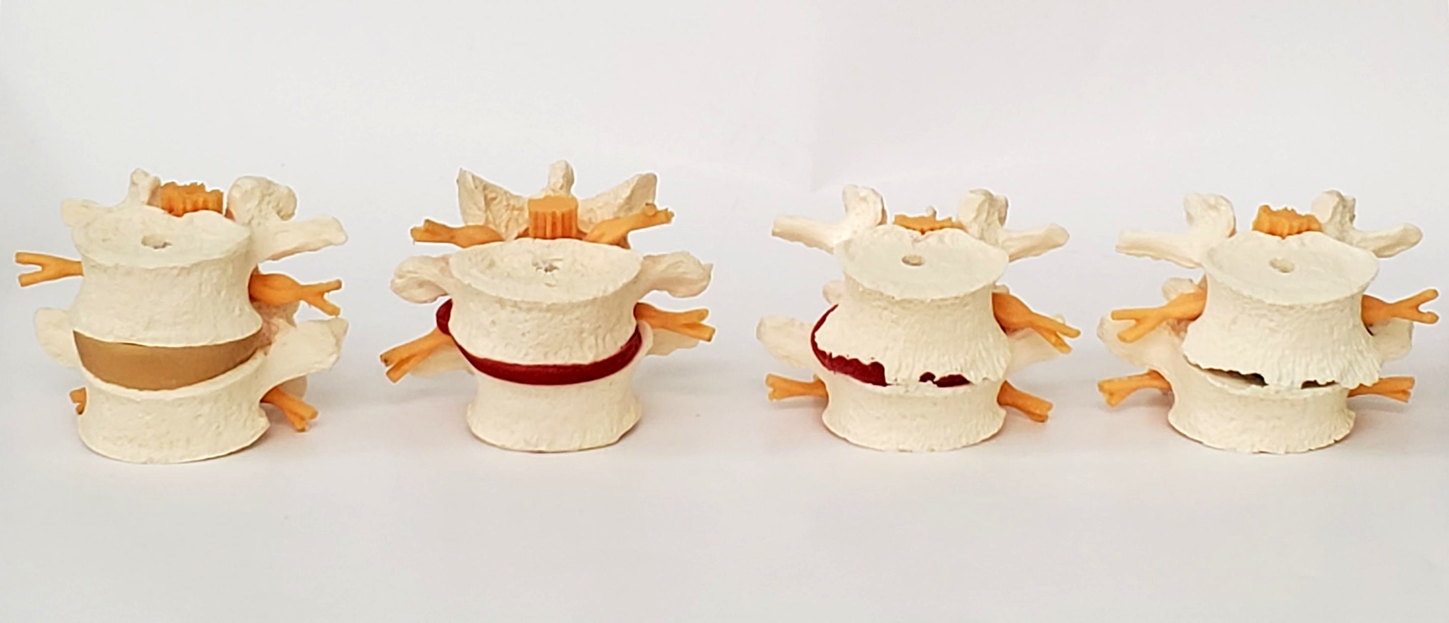 Spine Lumbar 4 Disk Degeneration: Models - Buyamag – Buyamag INC