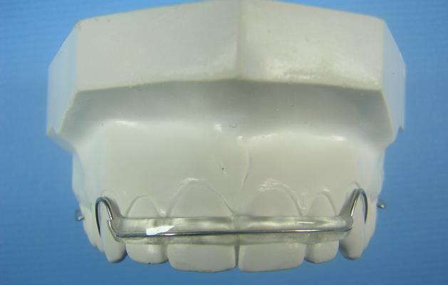 Modified Spring Retainer Orthodontic Model: Buyamag – Buyamag INC