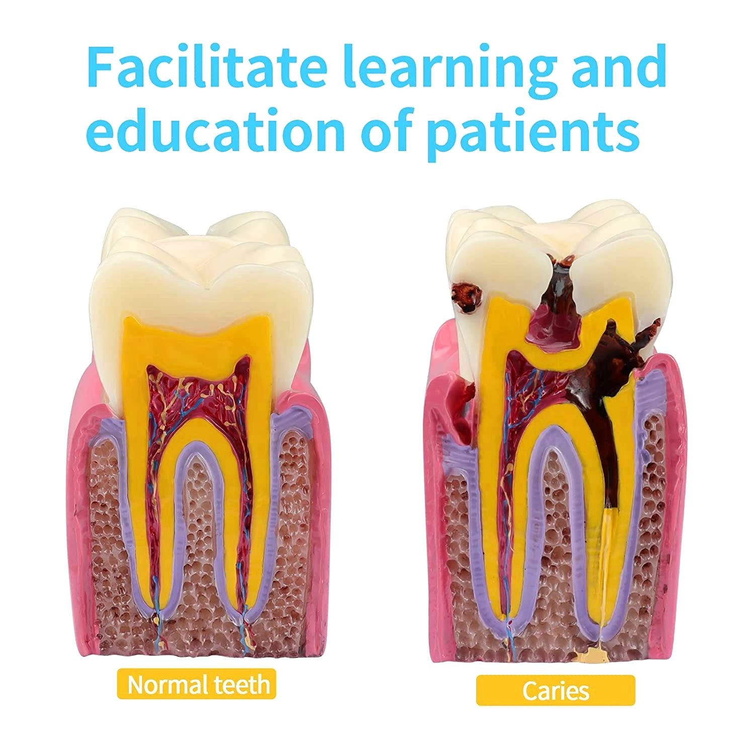 Teeth Caries Gum Disease Pathologies Model- Buyamag – Buyamag INC
